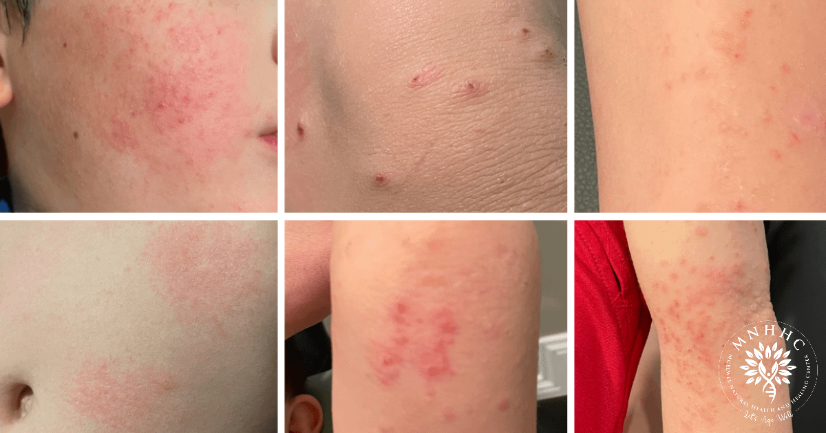 Rashes - McElwee Natural Health and Healing Center | Red Light Therapy ...